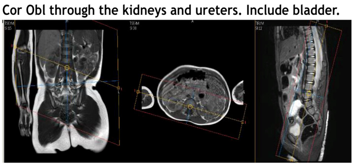 MR Urogram W/WO Protocol | OHSU